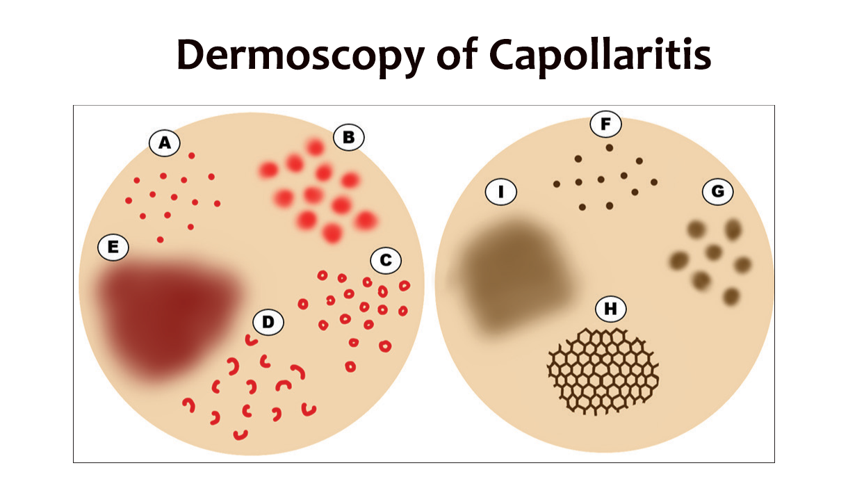 Can Dermatoscope Detect Capillaritis? – IBOOLO