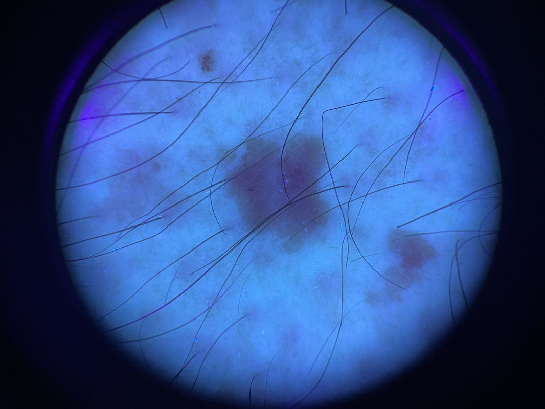 The world's best handheld dermoscope – IBOOLO